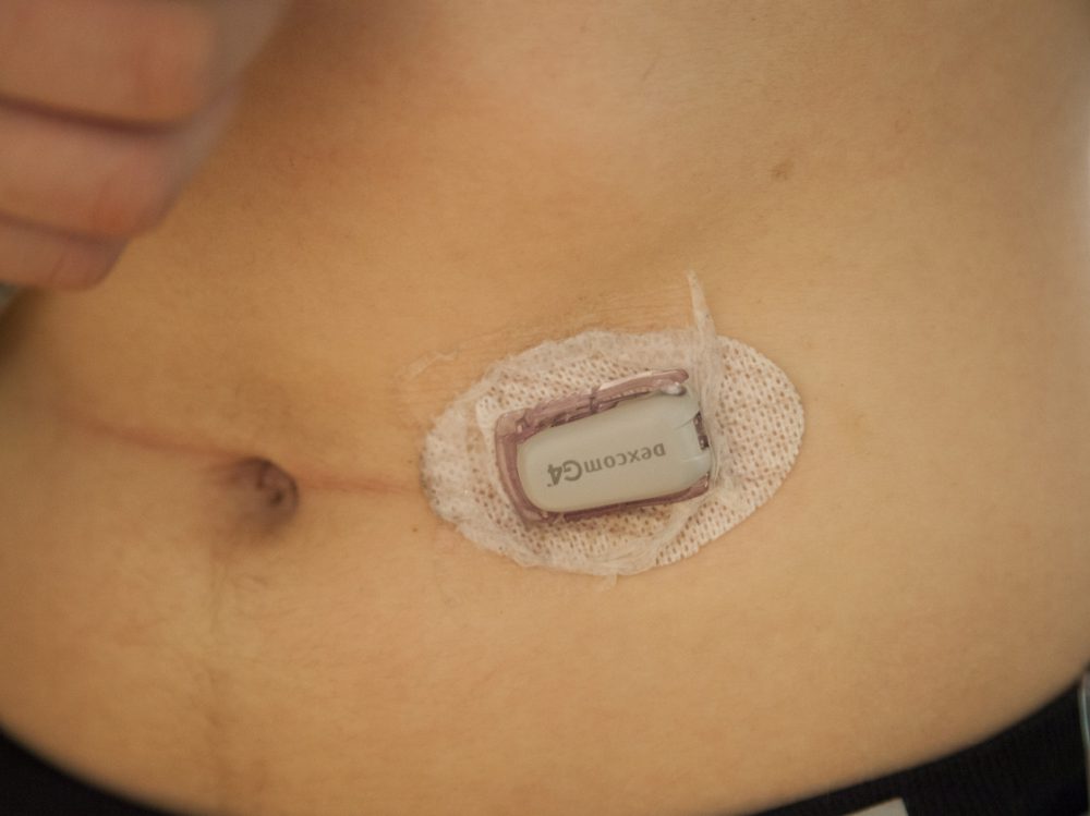 New 'Bionic Pancreas' Offers Hope To Type 1 Diabetics | Radio Boston